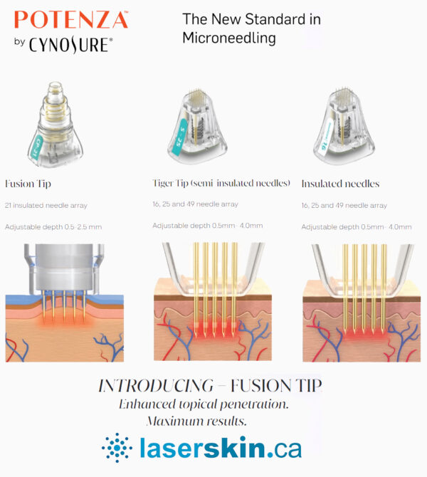 Rf Microneedling Before And After Potenza Rf Microneedling